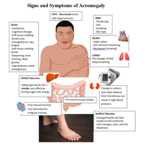 Acromegaly - WAPO